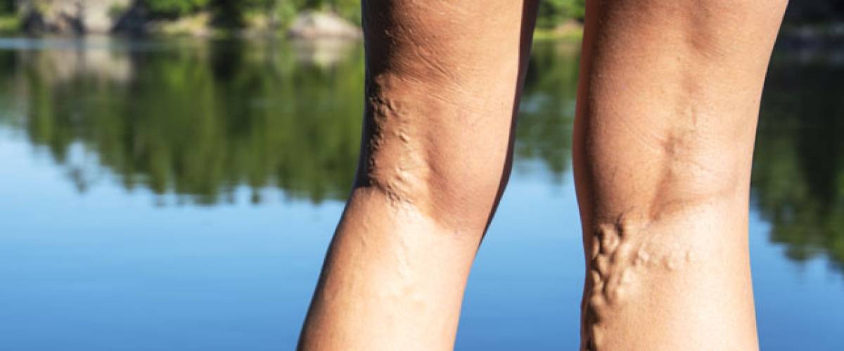 Alles over spataderen verwijderen | Ceulen Klinieken