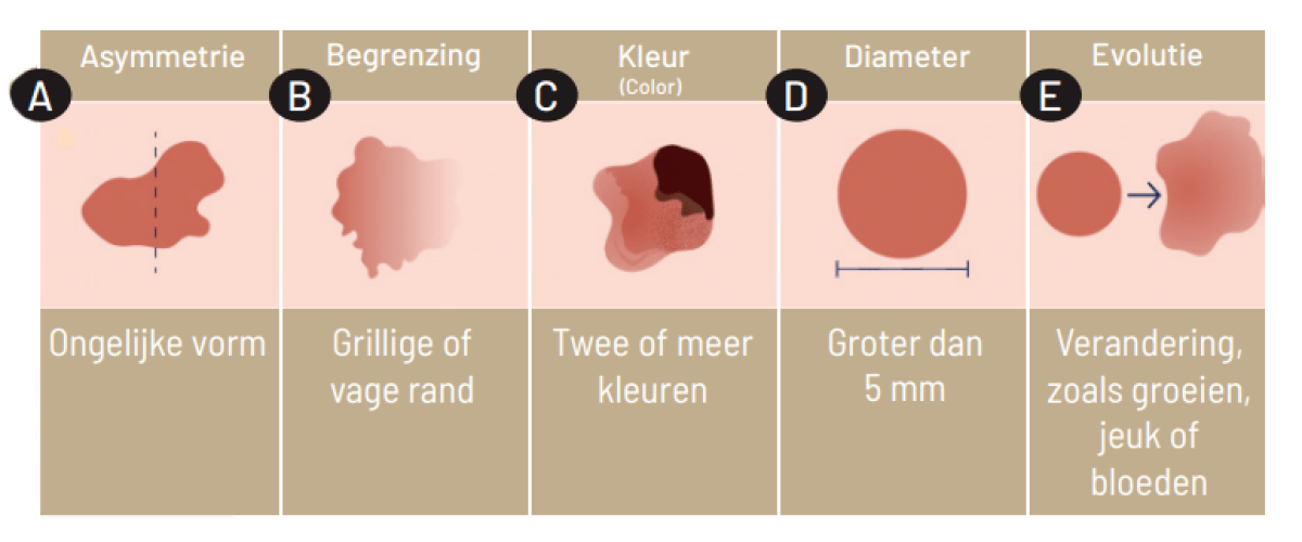 Herken huidkanker | Polikliniek Dermatologie Ceulen Klinieken